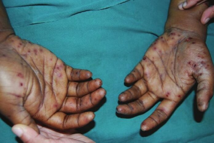 İnfektif Endocardit - Duke Kriterleri Hesaplama - Medhesap