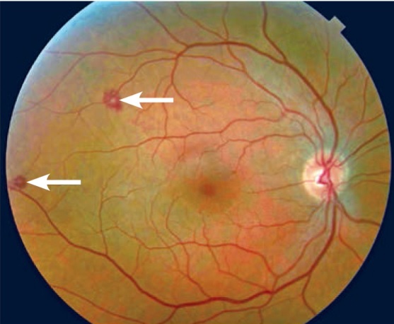 İnfektif Endocardit - Duke Kriterleri Hesaplama - Medhesap